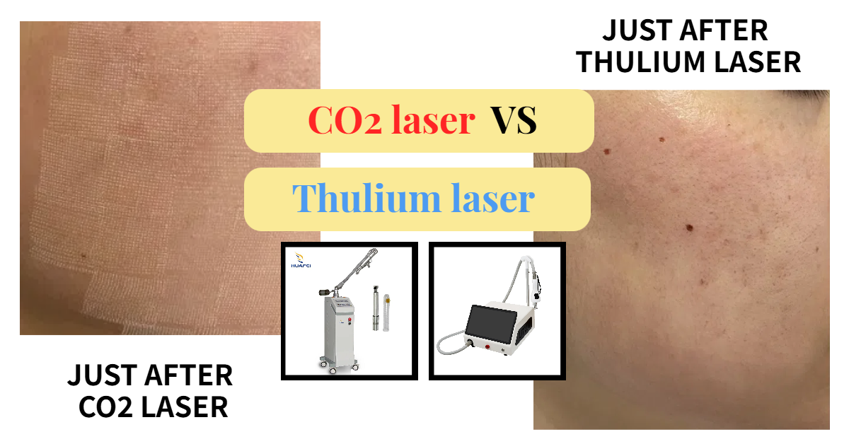 Fractional CO2 Laser vs Fractional Thulium Laser