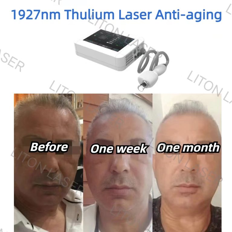 1550 & 1927 nm Dual Wave Thulium Laser for Melasma Treatment