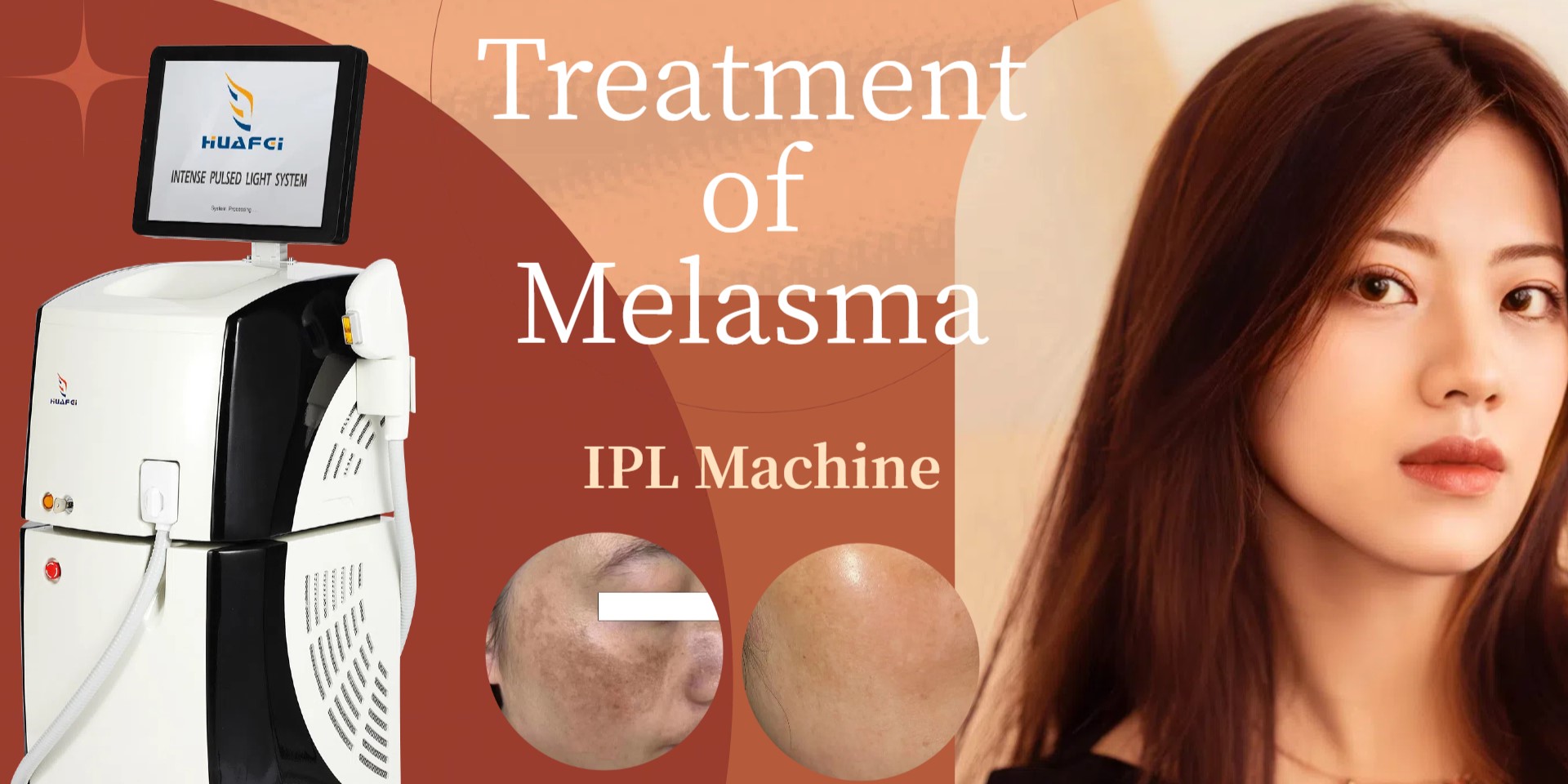 How Does IPL Intense Pulsed Light Treat Melasma? - Liton Laser