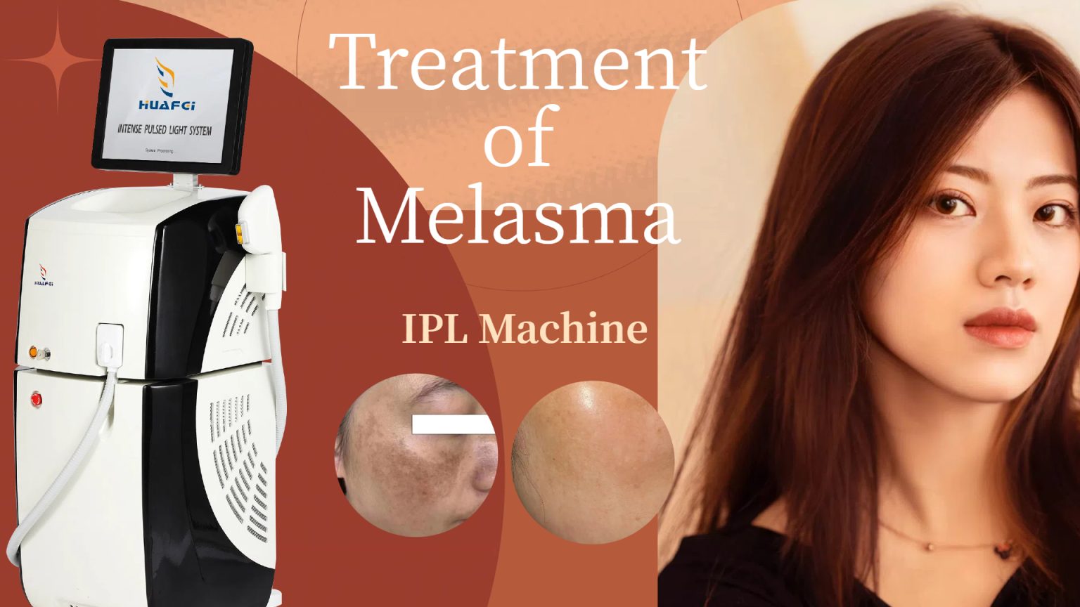 How Does IPL Intense Pulsed Light Treat Melasma? - Liton Laser